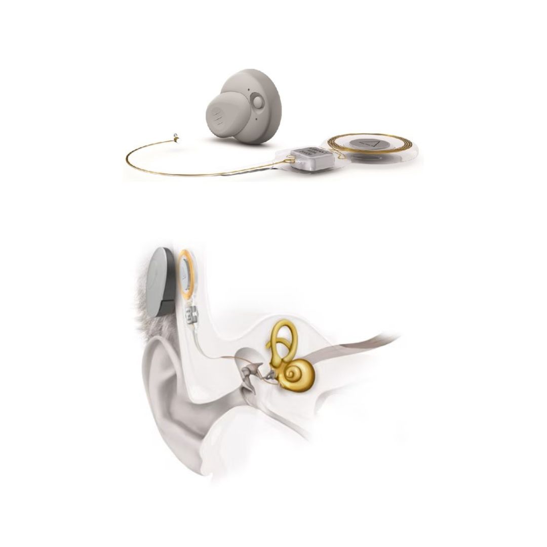 Vibrant Soundbridge (VSB) & Bone Bridge Hearing Aids in Delhi, Noida ...