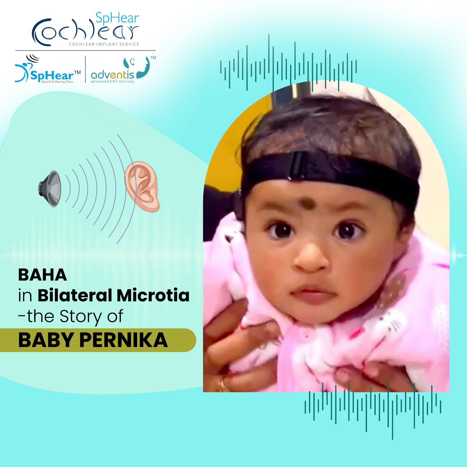 BAHA in Bilateral Microtia - the Story of Baby Pernika | SpHear Clinic