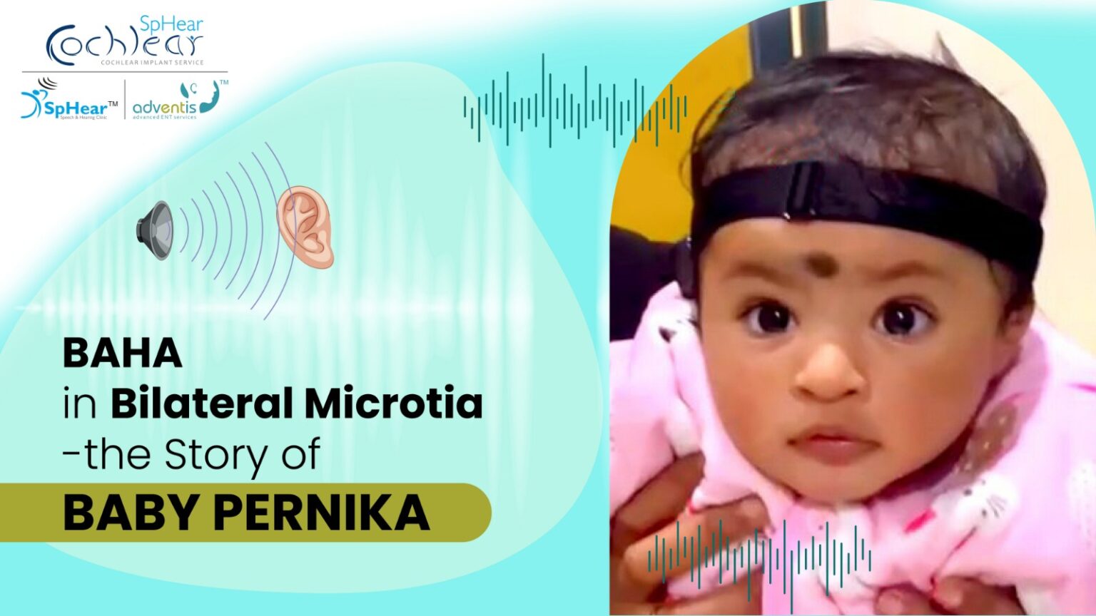 BAHA in Bilateral Microtia - the Story of Baby Pernika | SpHear Clinic