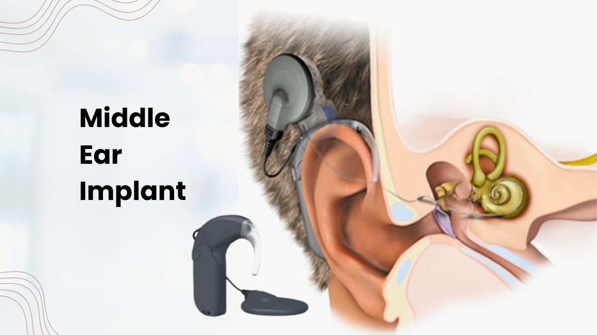 Middle Ear Implant Surgery & Treatment in Delhi, Noida & Patna